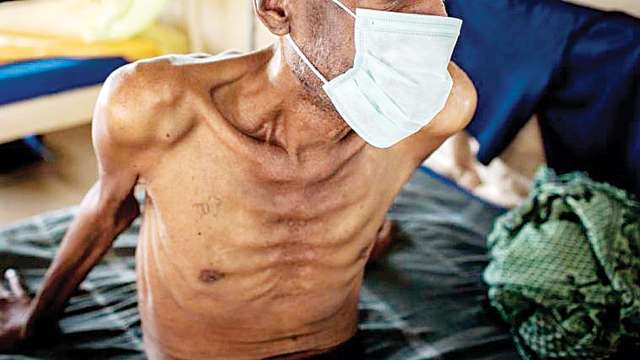 TB mukt India - Civilsdaily